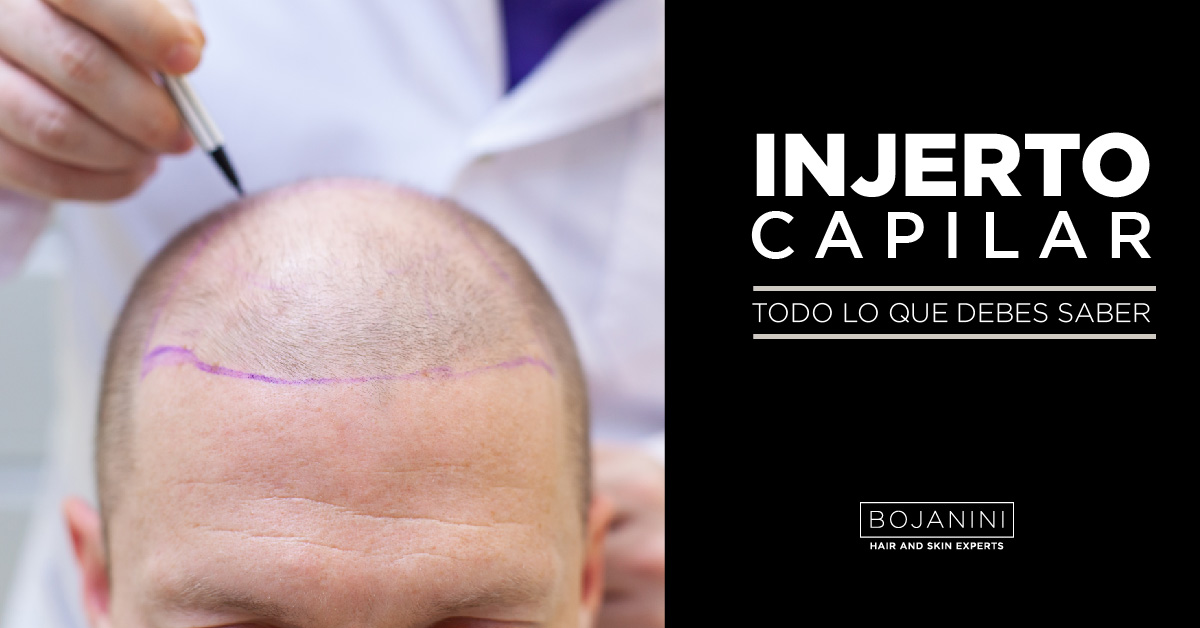 Injerto Capilar: Todo lo que debes saber | Bojanini Experts | España